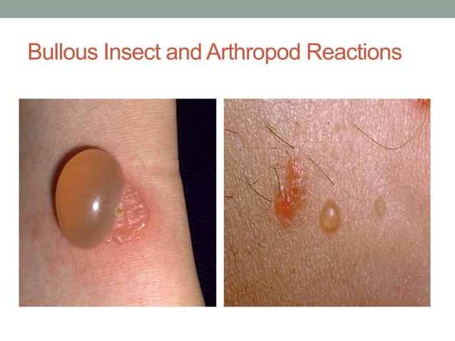 Bullous skin diseases | PPTX