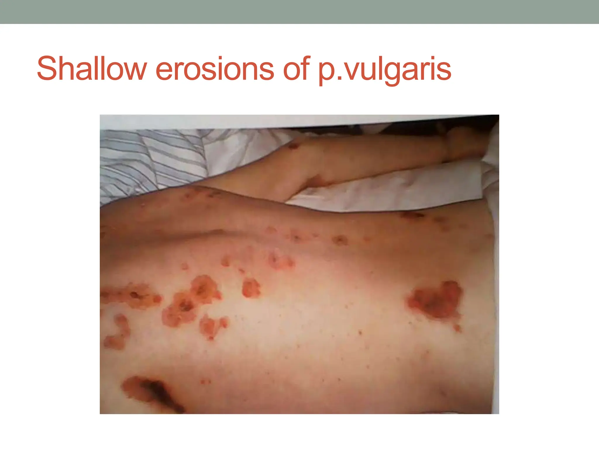 BULLOUS SKIN DISORDERS.ppt | Skin and Dermatology | Diseases and Conditions