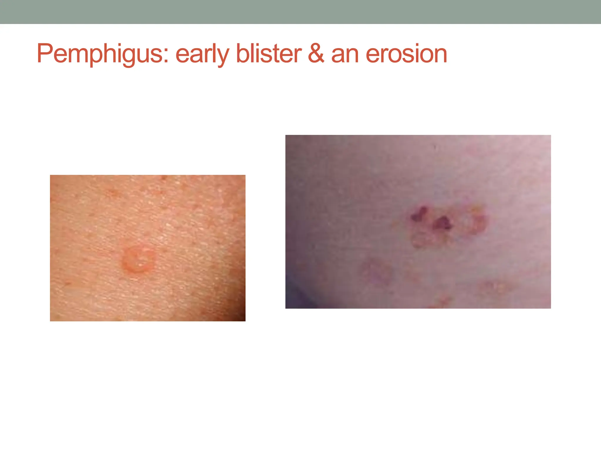 BULLOUS SKIN DISORDERS.ppt | Skin and Dermatology | Diseases and Conditions