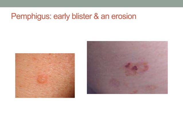 BULLOUS SKIN DISORDERS.ppt | Skin and Dermatology | Diseases and Conditions