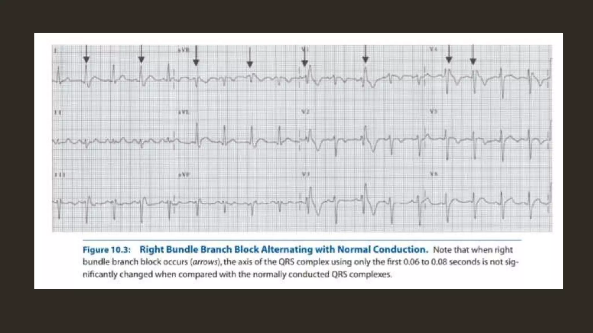 Bundle Branch Block | PPTX