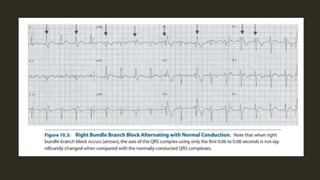 Bundle Branch Block | PPTX