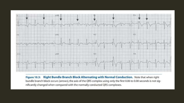 Bundle Branch Block | PPTX | Heart and Cardiovascular Diseases ...