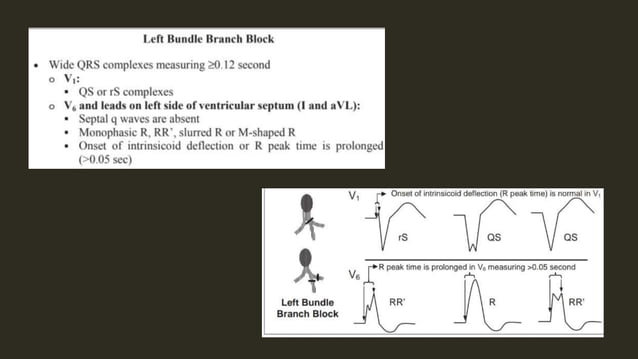 Bundle Branch Block | PPTX | Heart and Cardiovascular Diseases ...