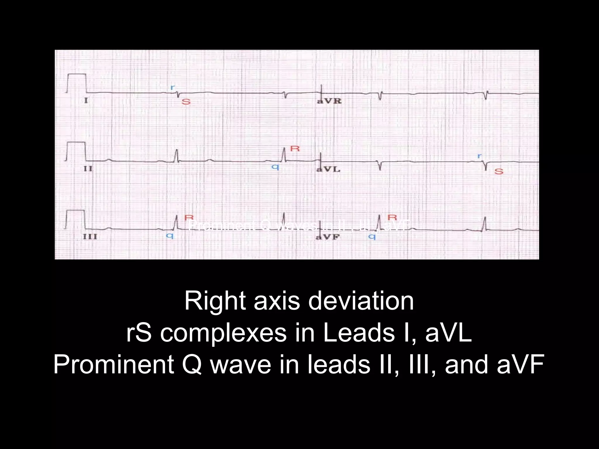 Bundle branch blocks by Dr Sujith Chadala | PPT