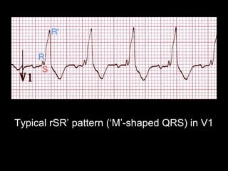Bundle branch blocks by Dr Sujith Chadala | PPT
