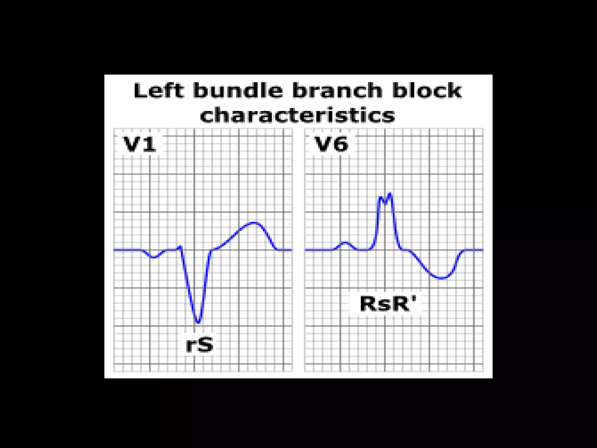 Bundle branch blocks | PPT