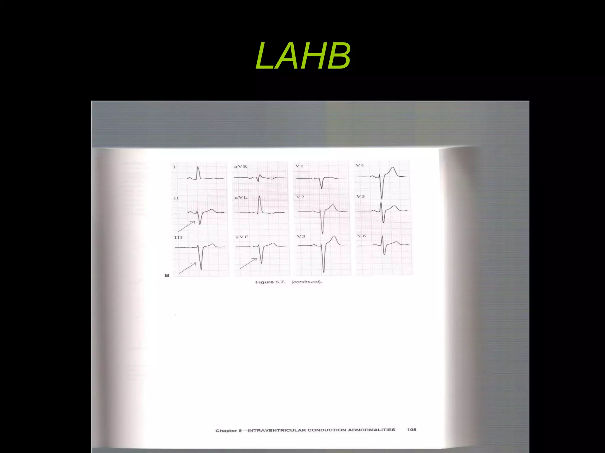 Bundle branch blocks | PPT