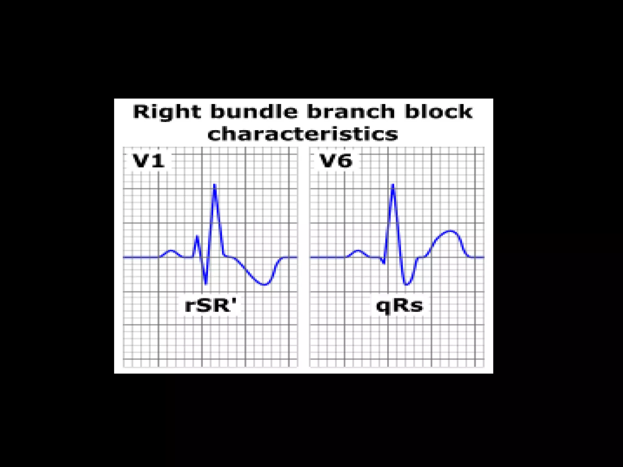 Bundle branch blocks | PPT
