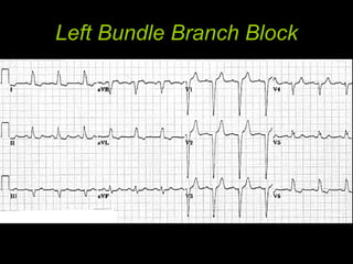 Bundle branch blocks | PPT