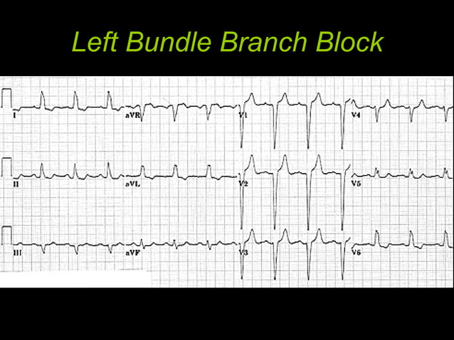 Bundle branch blocks | PPT | Heart and Cardiovascular Diseases ...