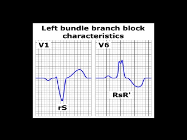 Bundle branch blocks | PPT | Heart and Cardiovascular Diseases ...