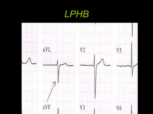 Bundle branch blocks | PPT | Heart and Cardiovascular Diseases ...