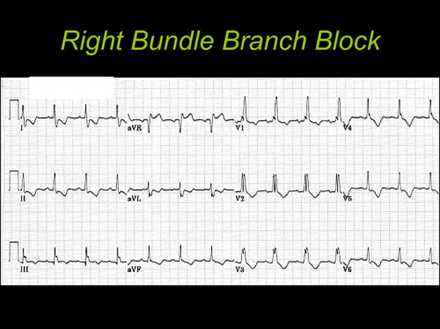 Bundle branch blocks | PPT | Heart and Cardiovascular Diseases ...