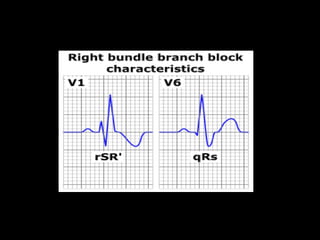 Bundle branch blocks | PPT