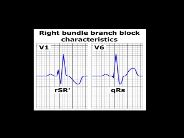 Bundle branch blocks | PPT | Heart and Cardiovascular Diseases ...
