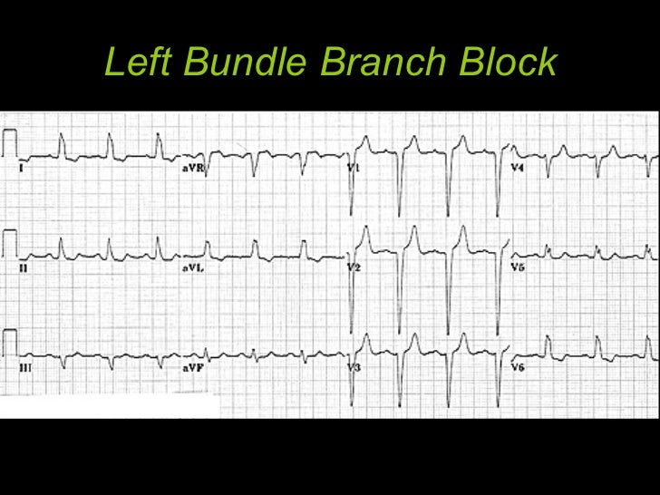 Bundle branch blocks