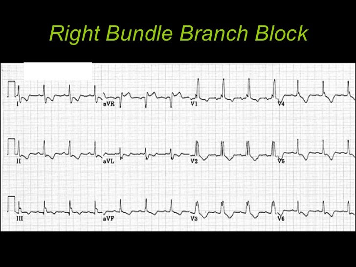 Right Bundle Branch Block