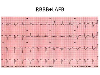Lafb Rbbb Ecg