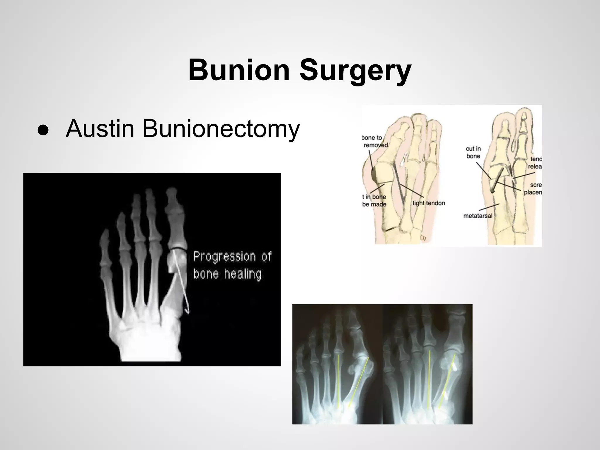 Bunion Presentation | PDF
