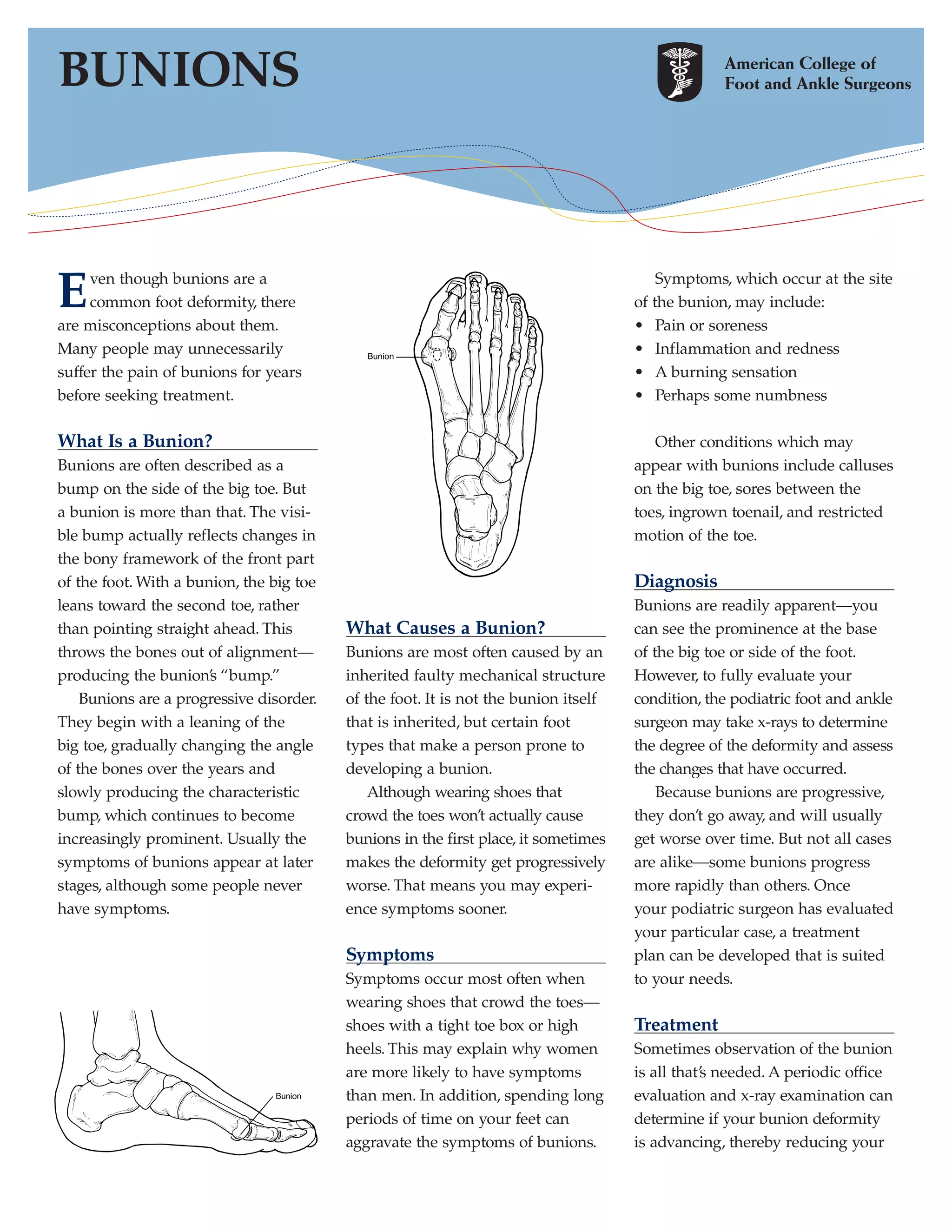 Bunions | PDF