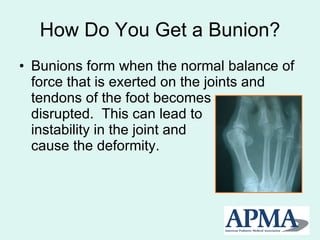 Bunions and Hammertoes: Symptoms and Treatment | PPT