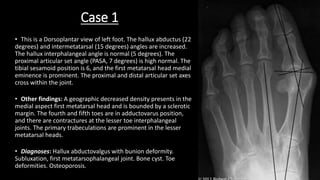 Bunion work - up | PPT