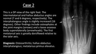 Bunion work - up | PPT