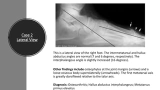 Bunion work - up | PPT