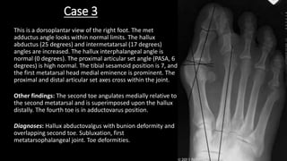 Bunion work - up | PPT