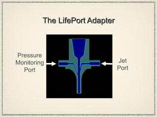Bunnell History and High Frequency Jet Ventilator Theory | PDF