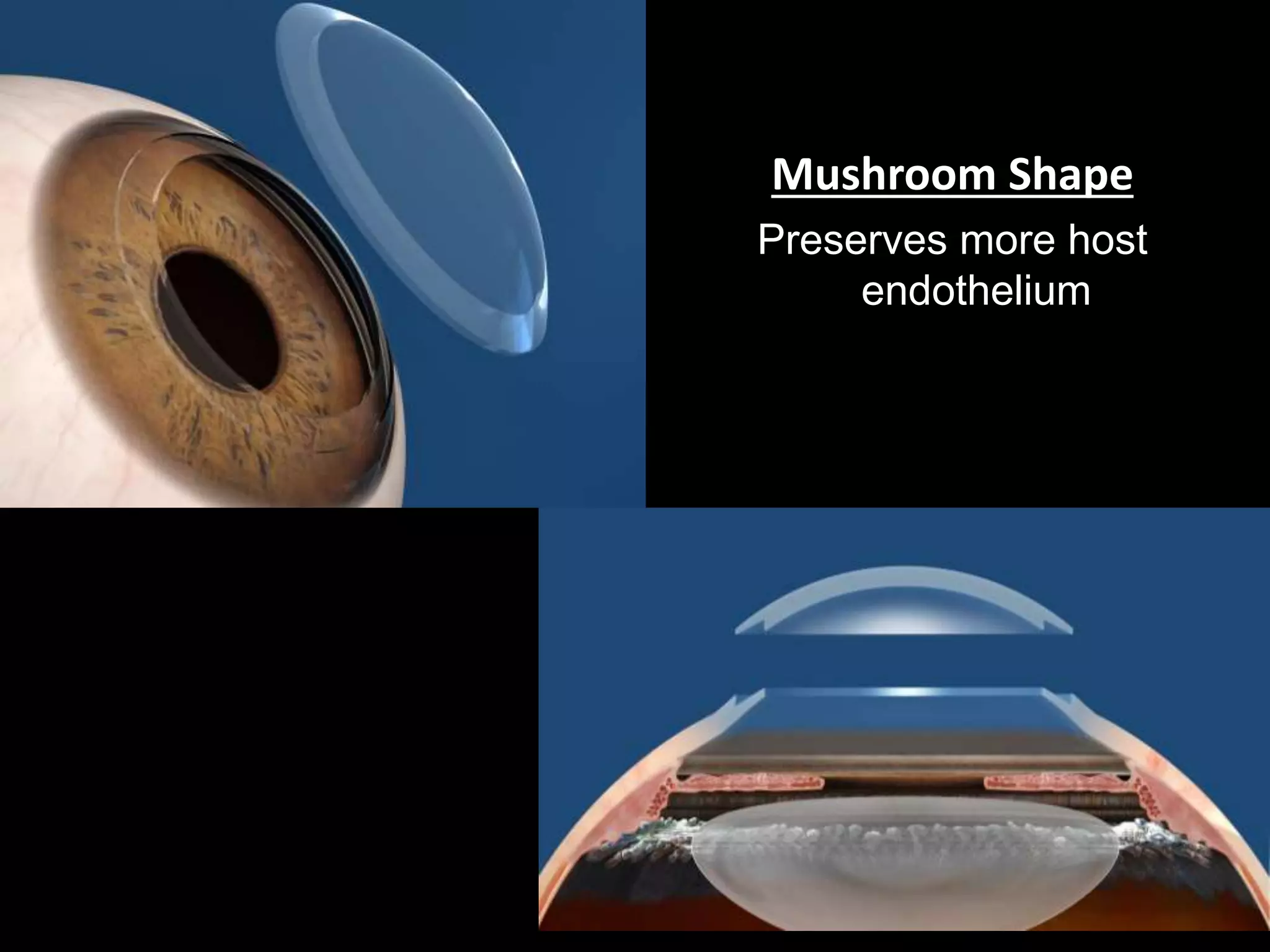 Penetrating keratoplasty by pushkar dhir | PPT