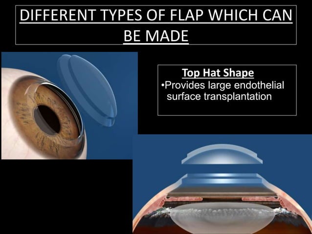 Penetrating keratoplasty by pushkar dhir | PPT