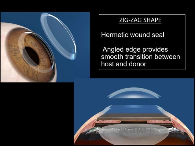 Penetrating keratoplasty by pushkar dhir | PPT