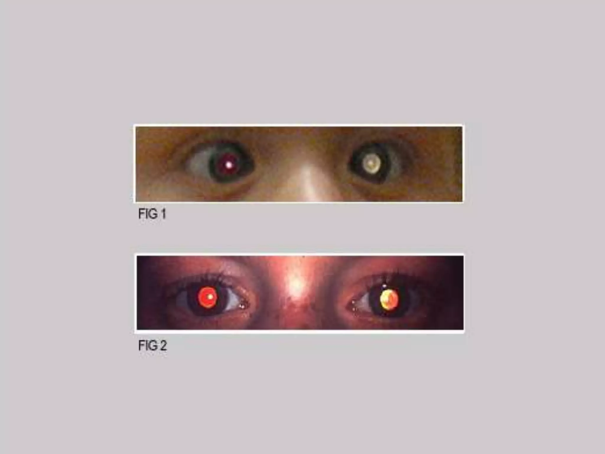 Burckner test or red reflex test | PPTX