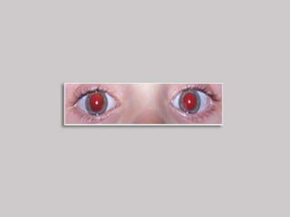 Burckner test or red reflex test | PPTX