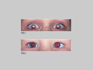 Burckner test or red reflex test | PPTX