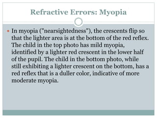Burckner test or red reflex test | PPTX