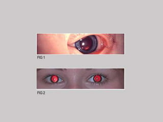 Burckner test or red reflex test | PPTX