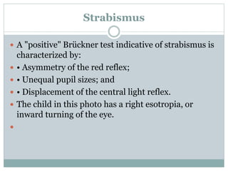 Burckner test or red reflex test | PPTX