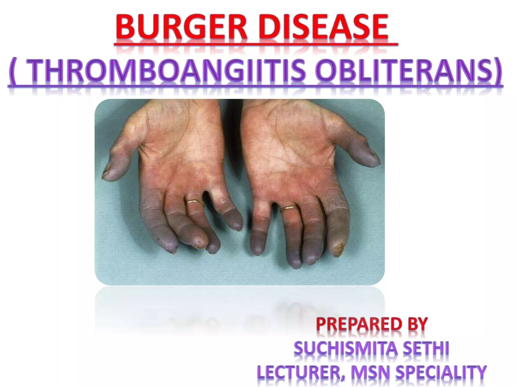 Burger disease | PPTX