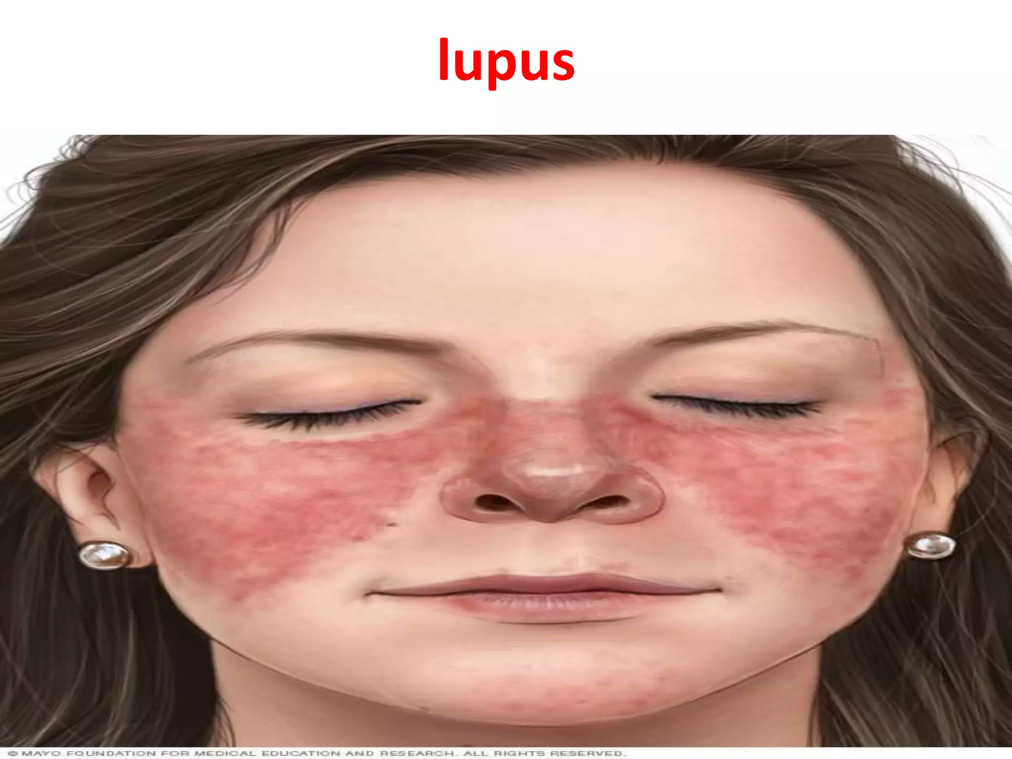 Burger disease | PPTX