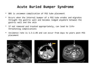 Buried bumper syndrome | PPT