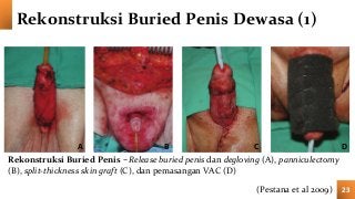 Buried Penis | PDF