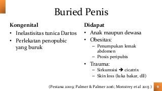 Buried Penis | PDF