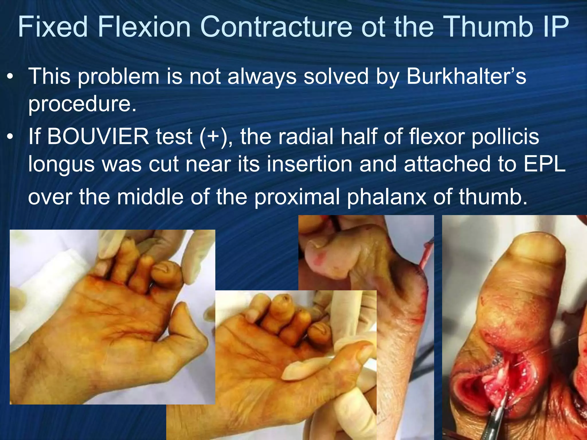 Burkhalter's Procedure | PDF