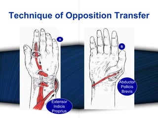 Burkhalter's Procedure | PDF