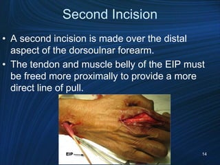 Burkhalter's Procedure | PDF