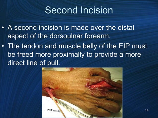 Burkhalter's Procedure | PDF | Death, Injury, or Military Conflict ...