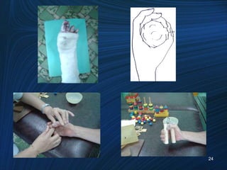 Burkhalter's Procedure | PDF